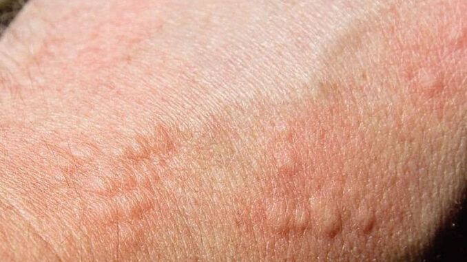 Dr. Ricardo Diez: Urticaria, su significado – Diario El Telégrafo